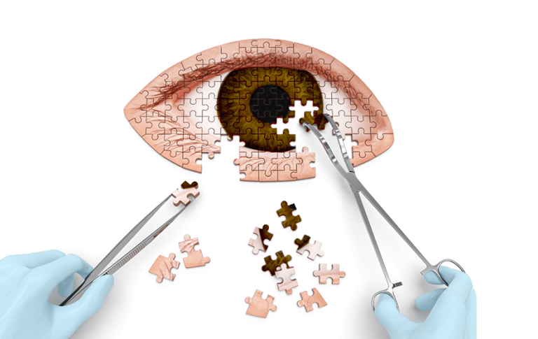 Tracing the Evolution of Modern Refractive Eye Surgeries