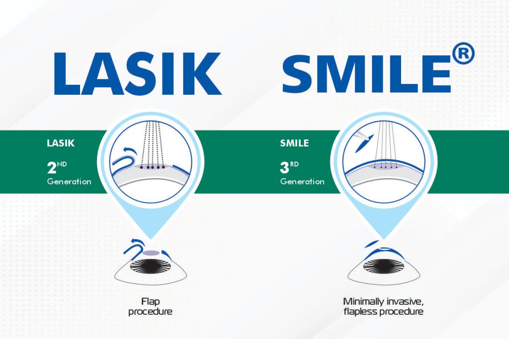 LASIK vs SMILE Eye Surgery: Which Vision Option Is Better?
