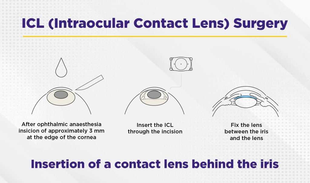 Top Benefits of Implantable Collamer Lens (ICL) Surgery