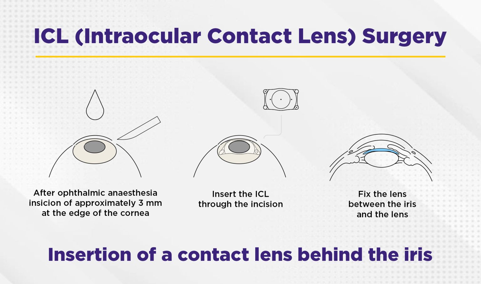 Unlocking 6 Major Advantages of Implantable Collamer Lens | Planet Lasik