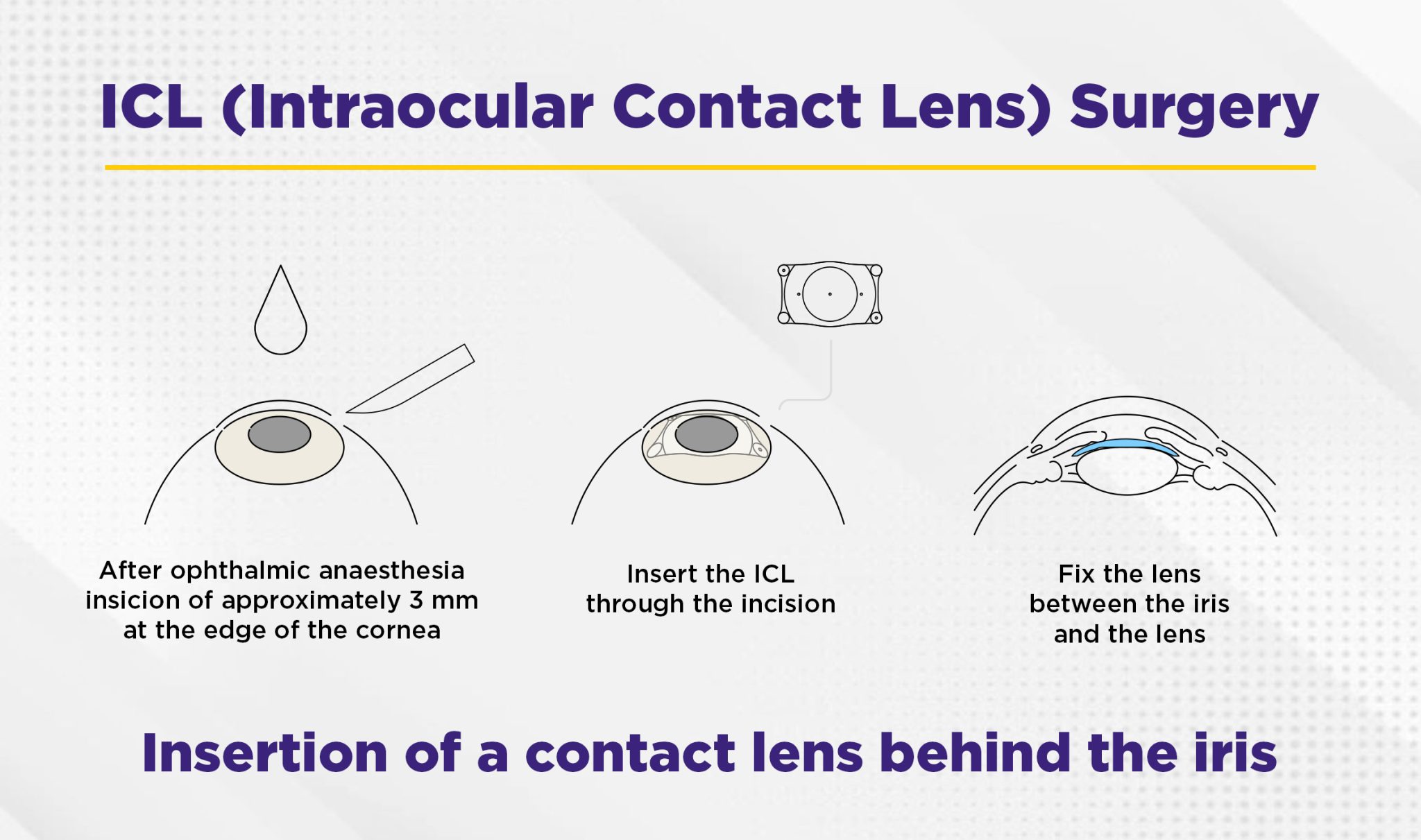 Top Benefits of Implantable Collamer Lens (ICL) Surgery