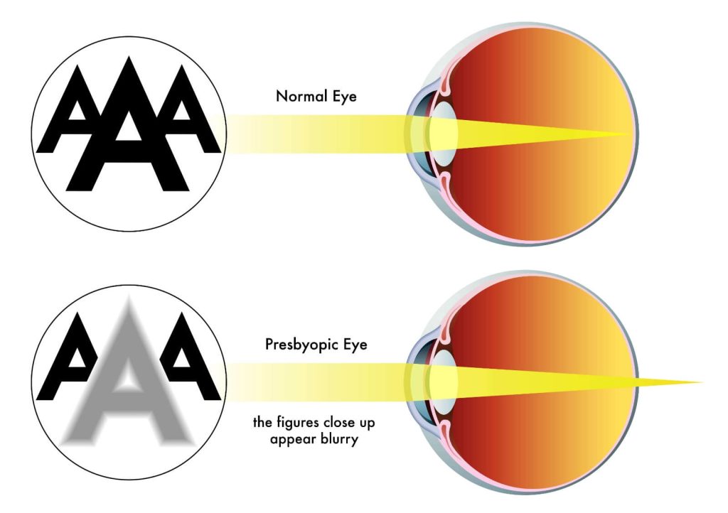 Discover the Causes of Presbyopia and How to Manage It