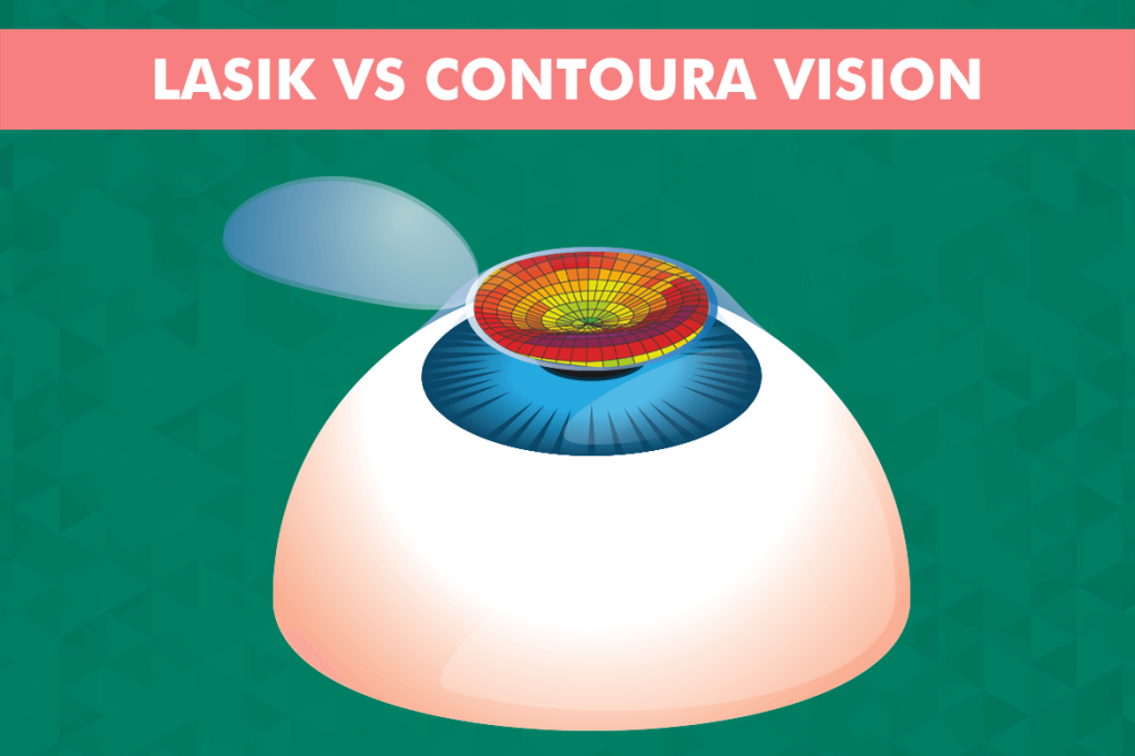 Contoura Vision Vs Lasik - What's The Difference? | Planet Lasik