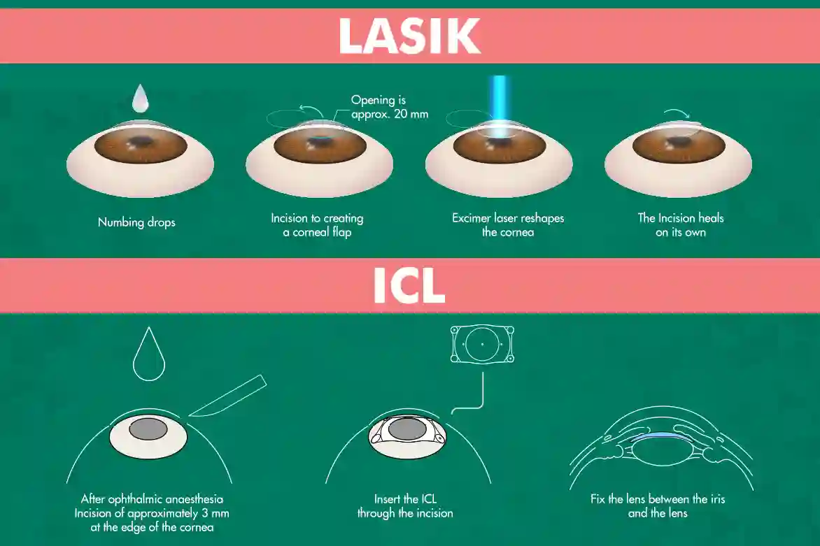 LASIK or ICL? Find the Best Vision Correction for Your Needs