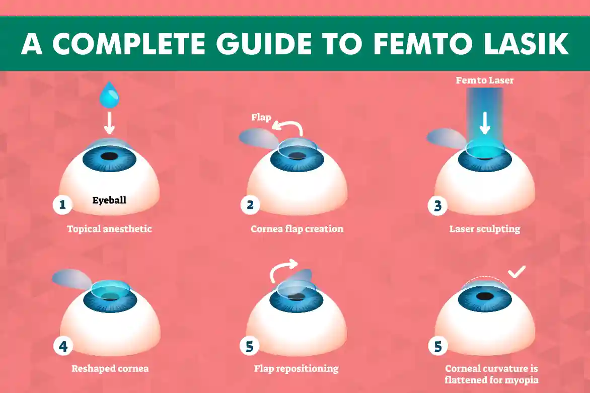 Preparing for Femto LASIK: Before, During & After Surgery