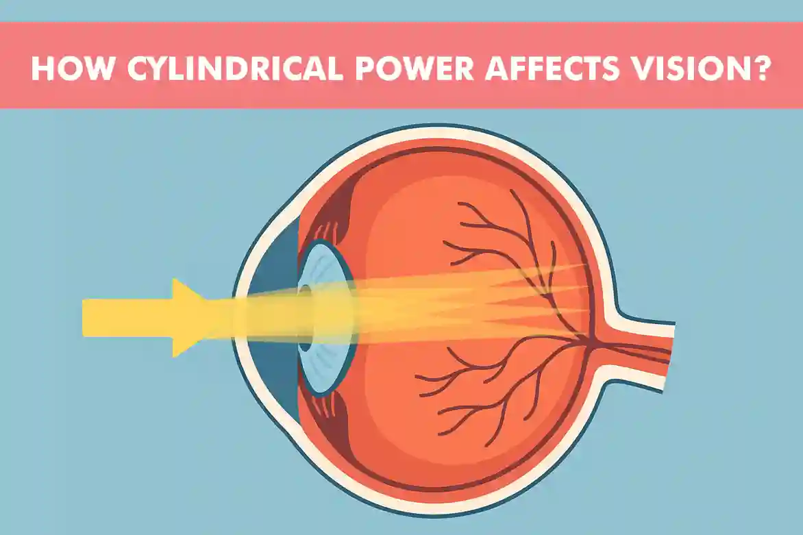 Cylindrical Power Causes, Symptoms & Treatment Options