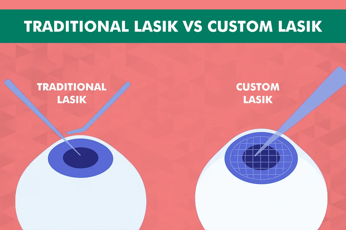 Traditional vs Custom LASIK: Key Differences Explained | Centre For Sight
